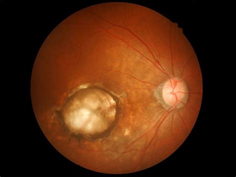 Atrophic Retinal Hole With Fluid