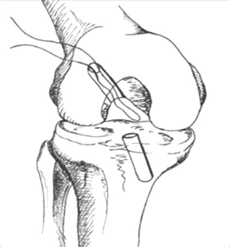 Standard Femoral Tibial Tunnel Download Scientific Diagram Standard Femoral Tibial Tunnel Download Scientific Diagram