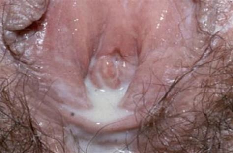 Gonorreia O Que Transmiss O Sintomas E Tratamento