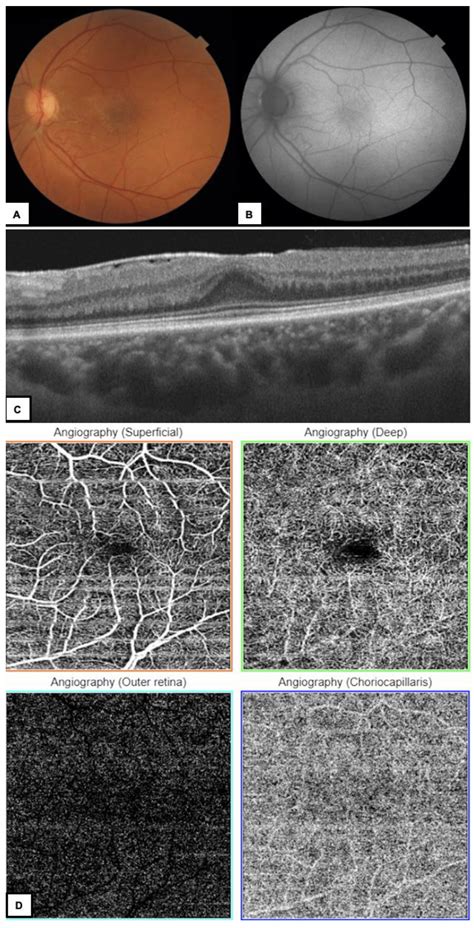 Unilateral Tamoxifen Induced Retinopathy As A Consequence Of Breast