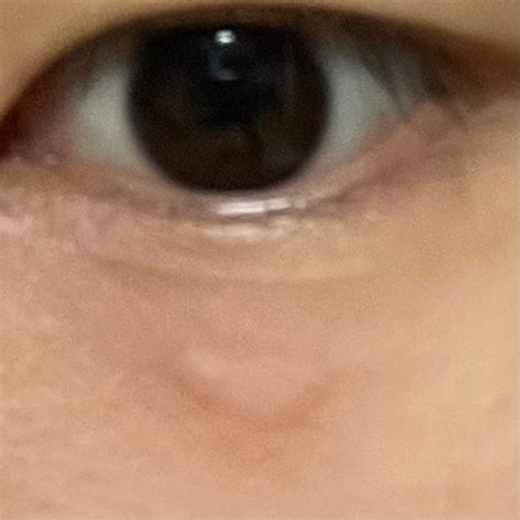 눈 밑에 다래끼인가요 지식in