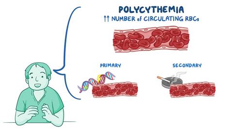 Video Polycythemia Nursing Osmosis