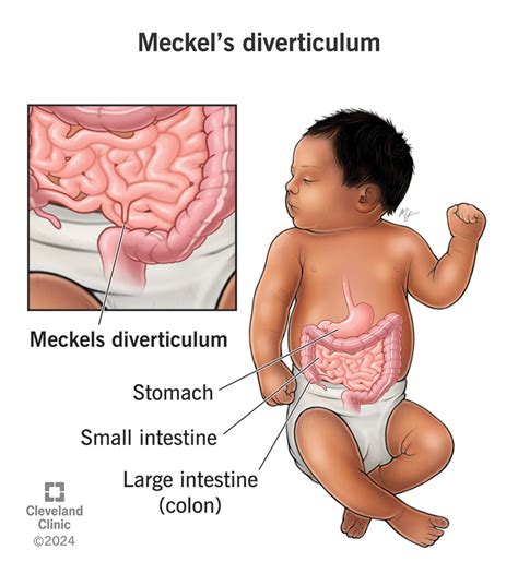Meckels Diverticulum
