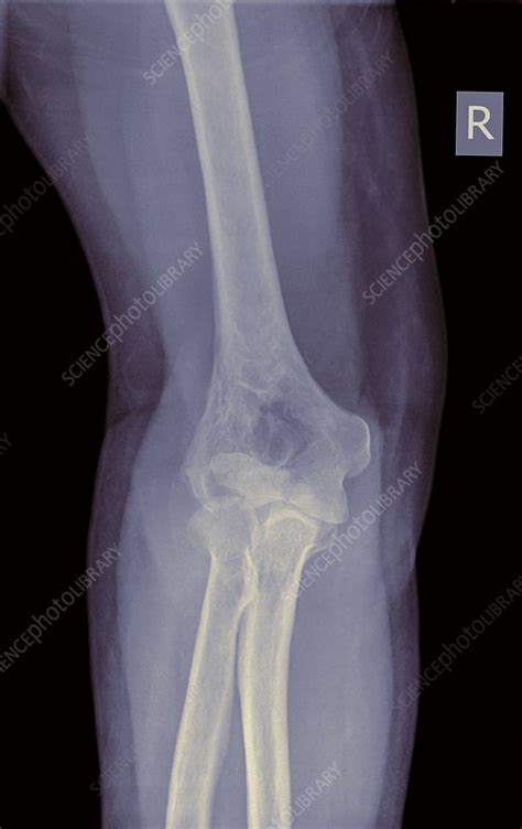 Leg X Ray Stock Image C0197274 Science Photo Library