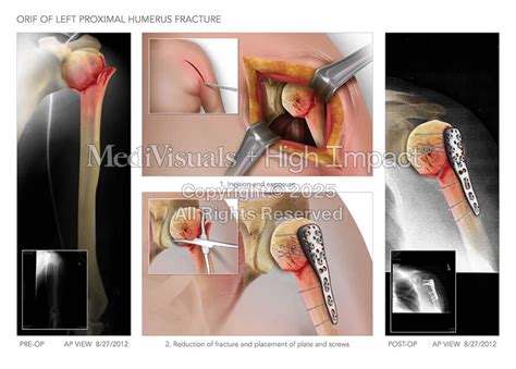 Open Reduction Internal Fixation Of Humerus Fracture Medivisuals High Impact