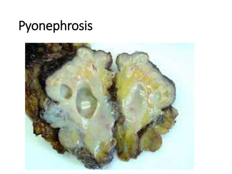Obstructive Uropathy 1 Pptx Medical Health