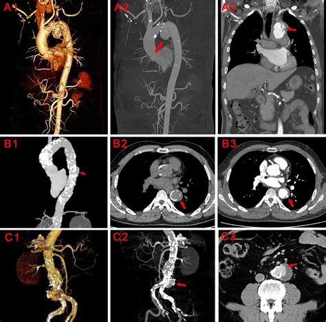 Examples Of Paupseudoaneurysm Evaluation A1 A3 Example Of Pau At