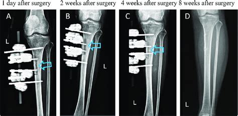 Evaluation Of Ttt Using Radiographs A The Position Of Corticotomy And Download Scientific