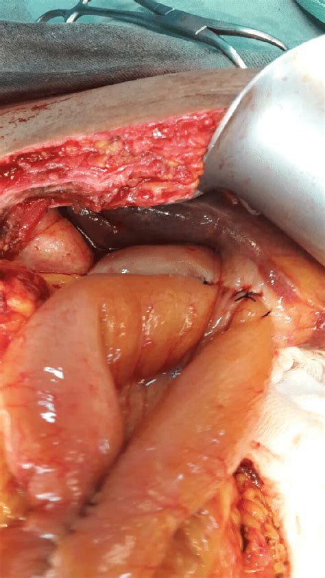 Palliative Cholecystojejunostomy Bypass Procedure Download