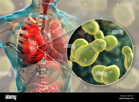 Pulmonary Cryptococcosis Invasion Of A Lung Tissue By Yeast Fungi Pulmonary Cryptococcosis Invasion Of A Lung Tissue By Yeast Fungi