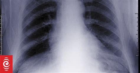 Womans Cancer Diagnosis Delayed After Waikato Hospital Failed To Follow Up On X Ray Rnz News