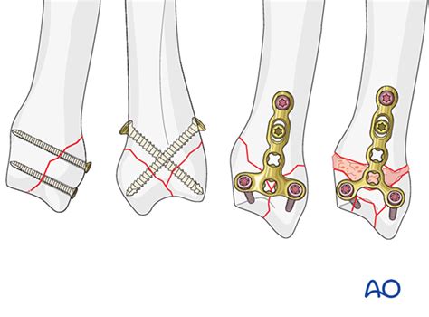Orif For Dislocation And Fracture Dislocation Of The Carpometacarpal Joint