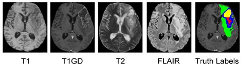 3d U Kan Implementation For Multi Modal Mri Brain Tumor Segmentation Ai Research Paper Details