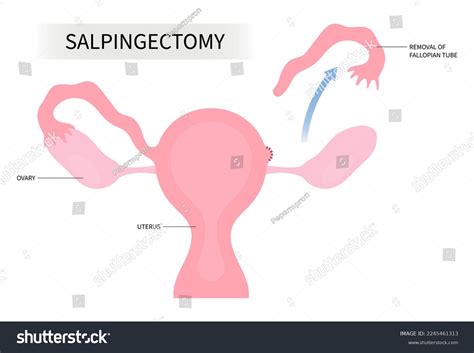Anatomy Uterus Pain Surgical Biopsy Hormone Stock Vector Royalty Free