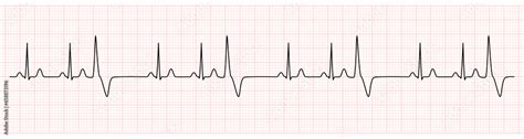 Poster Ekg Monitor Showing Sinus Rhythm With Trigeminy Pvc Wall Art