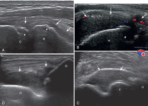 УЗИ патологии локтевого сустава и его синовиальных сумок