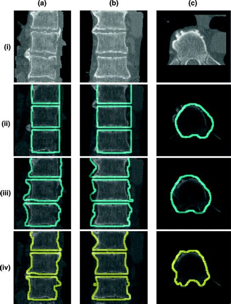 Segmentation Reconstruction And Analysis Of The Vertebral Body From Spinal CT Radiology Key