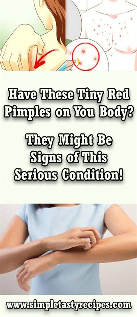 Have These Tiny Red Pimples On You Body They Might Be Signs Of This Serious Condition
