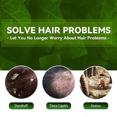 Antiitch Shampoo For Tinea Capitis To Dandruff And Relieve Itchy Scalp Nn Fruugo Uk