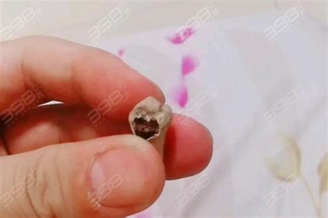 智齿黑了蛀牙第4页大山谷图库