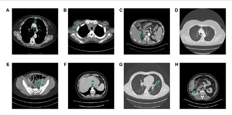 Figure 1 From A Universal Lesion Detection Method Based On Partially Supervised Learning