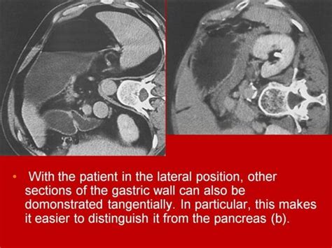 Whole Body Computed Tomography Git Ppt