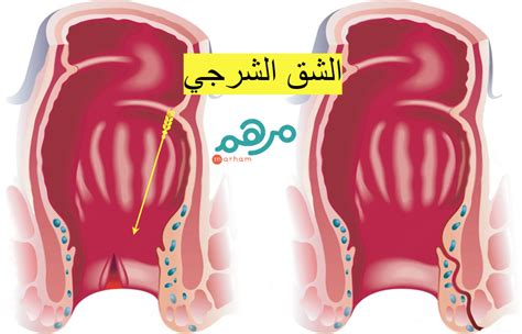 كيف تمنع الشق الشرجي؟ منصة مرهم