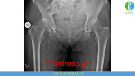Hip Joint X Ray Imaging