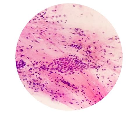 20 Precancerous Pictures