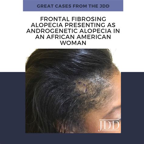 Frontal Fibrosing Alopecia Presenting As Androgenetic Alopecia In An My XXX Hot Girl