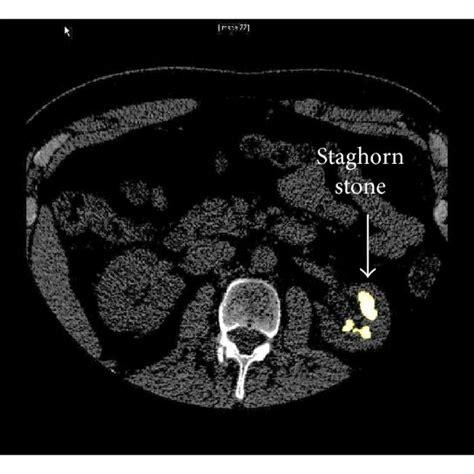 Dect Scan With Advanced Postprocessing Which Identified The Stone Download Scientific Diagram