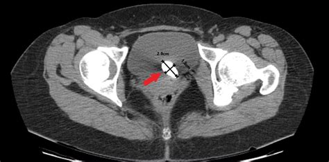 Axial Plane Of Computed Tomography Ct Urography Depicting A Large Download Scientific Diagram