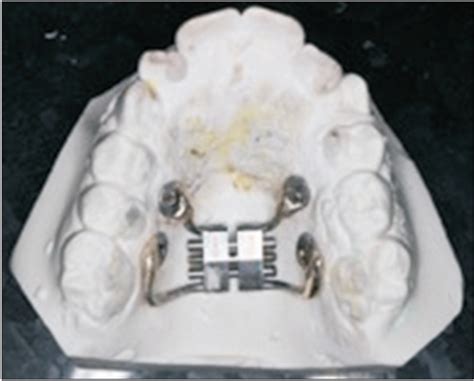 Effectiveness Of Low Level Laser Therapy In Facilitating Maxillary