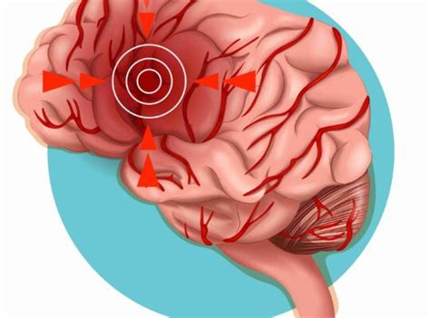 أمراض واضطرابات عصبية عرب ثيرابي