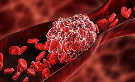 Eves Protocol Launched To Optimise Care Of Patients With Vte In Ireland Medical Independent
