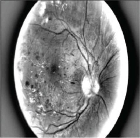 Proliferative Diabetic Retinopathy With Random Shifted Augmentation