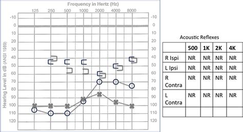 Clinical Evaluation Of The Patient With Otosclerosis Otolaryngologic