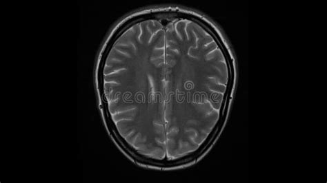Mri Brain Scan Magnetic Resonance Image Ct Scan Of Human Brain In