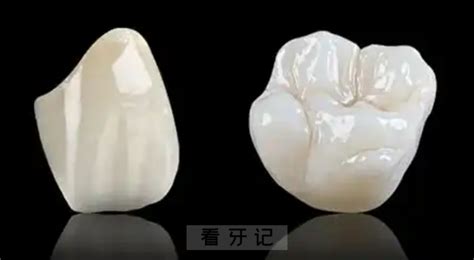种植牙牙冠用进口的好还是国产的好？有哪些品牌值得推荐？全新2025牙冠价格价目表整理 看牙记网
