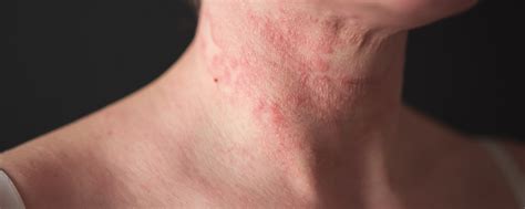 Dermatitis Alles über Symptome Auslöser Und Behandlung