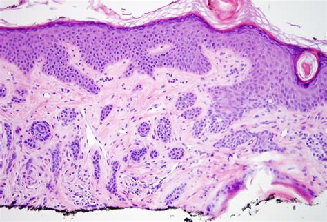 Desmoplastic Trichoepithelioma Dermatopathology