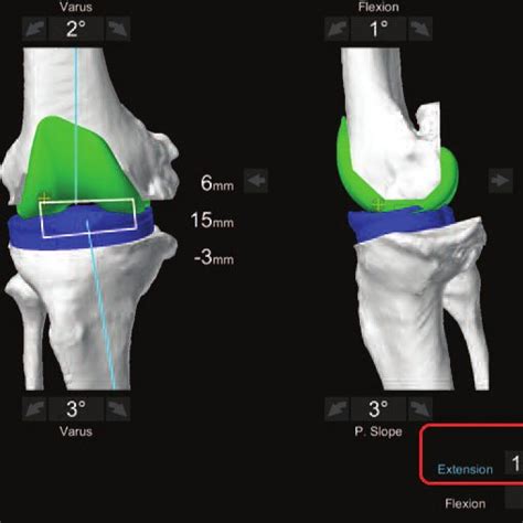The Tibial Resection Was Reduced By 4mm And Distal Femoral Resection Download Scientific