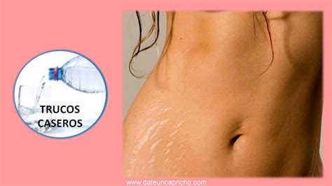 Como Eliminar Las Estrías Naturalmente Tratamiento Casero Para Las