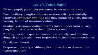 Pupil And Its Disorders Pptx