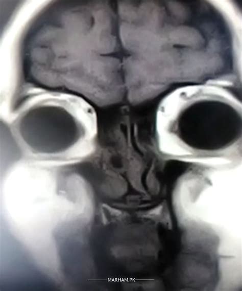 Ask A Ent Online For Ride Side Dns With Nose Blockage Plus Patu