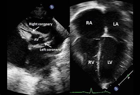 2 Cases Of Arrhythmogenic Syncope In Adolescents