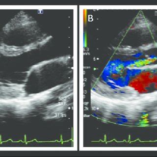 Echocardiography A Long Axis View Plain B Long And Short Axis View Download Scientific