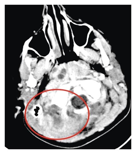 Irregular Hypodensity Below The Right Mastoid And Right Half Of The Download Scientific Diagram