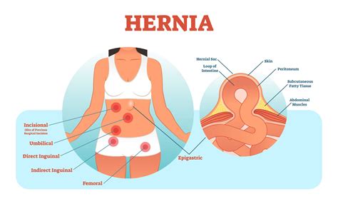 How Anyone Can Get A Hernia Including Women Health News Hub