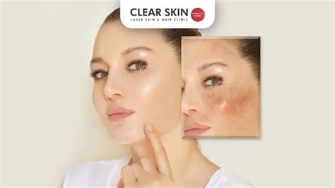 How To Treat Melasma Effectively With Topical Medications